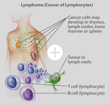 What is Lymphoma: Signs, Symptoms, Types & Stages | CTCA